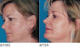 Obagi Blue Peel | Cosmetic Skin Care | Dr. Lawrence Kass