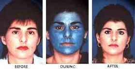 Obagi Blue Peel | Cosmetic Skin Care | Dr. Lawrence Kass