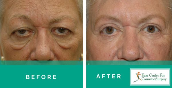 Festoons | Cosmetic Surgery Gallery